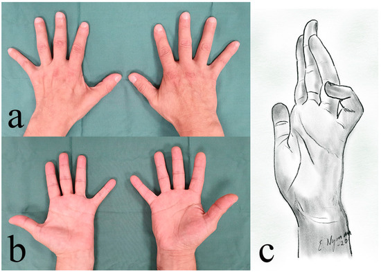 The Unpredictable Ulnar Nerve—Ulnar Nerve Entrapment from Anatomical ...