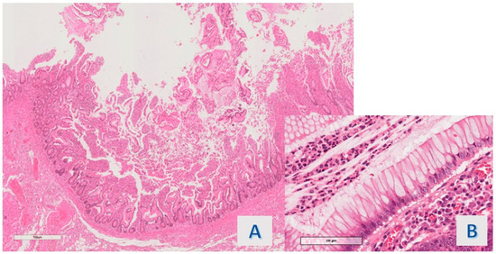 Hyper Mucinous Proliferations in the Mucosa of Patients with ...