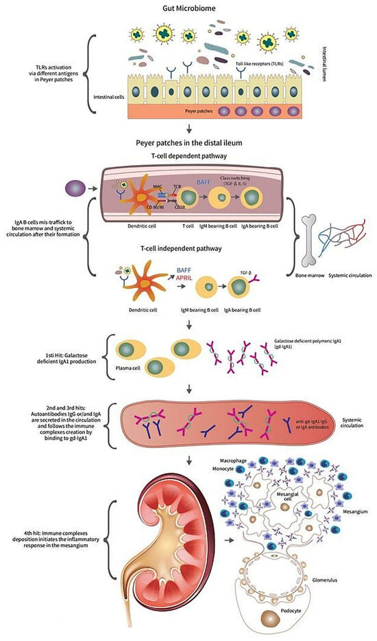 Diagnosing and Treating IgAN: Steroids, Budesonide, or Maybe Both?
