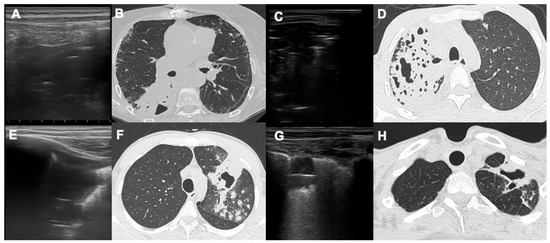 Parenchymal Cavitations in Pulmonary Tuberculosis: Comparison between ...
