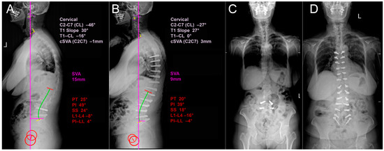 Use of Dynamic Spinal Instruments (Dynesys) in Adult Spinal Deformities ...