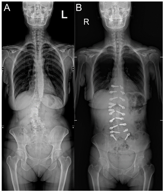 Use of Dynamic Spinal Instruments (Dynesys) in Adult Spinal Deformities ...
