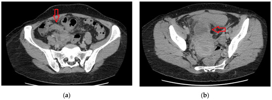 A Unique Case of Appendiceal Intussusception (Inversion): A Case in Bloom