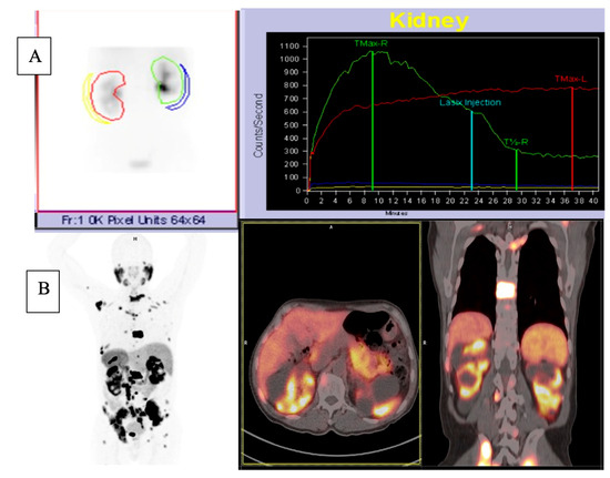 A Comparison of 68Ga-PSMA PET/CT-Based Split Renal Function with 99mTc ...