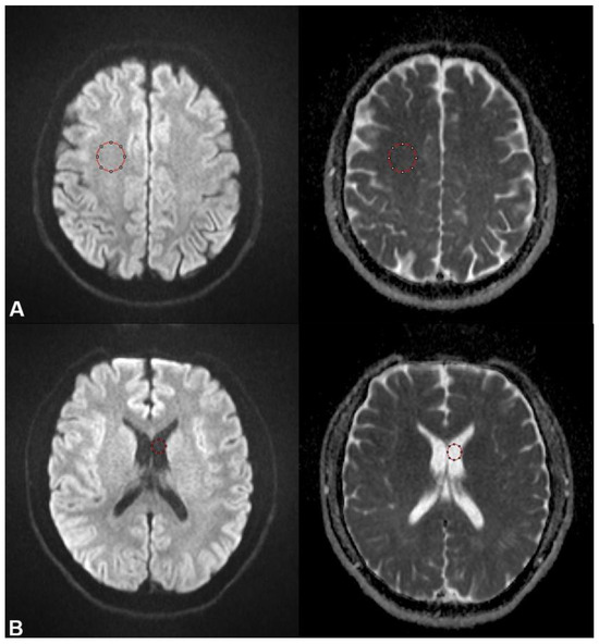 Whole Process of Standardization of Diffusion-Weighted Imaging: Phantom Validation and Clinical ...