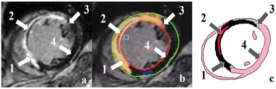 Cardiac Magnetic Resonance Imaging Based Ischemic Injury Pattern in Patients with Acute ...