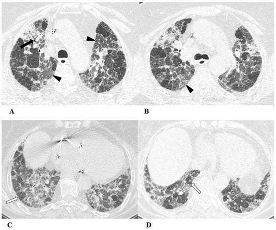 Pulmonary Adverse Events in Cancer Immunotherapy: Case Studies of CT ...