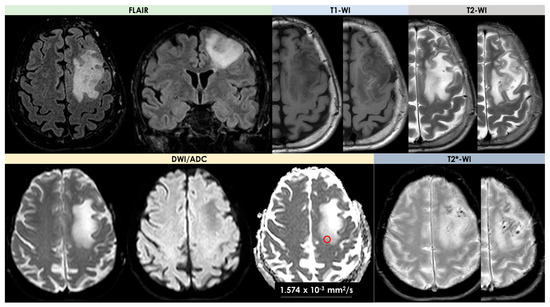 Diagnostics | Free Full-Text | Tumor-like Lesions in Primary Angiitis of the Central Nervous ...
