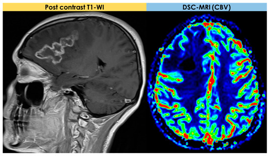 Tumor-like Lesions in Primary Angiitis of the Central Nervous System ...