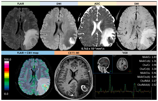 Diagnostics | Free Full-Text | Tumor-like Lesions in Primary Angiitis of the Central Nervous ...