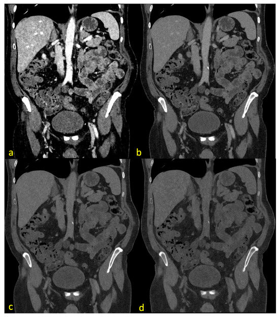 Optimizing Arterial Vessel Contrast in Portal Venous Phase with Virtual Monoenergetic Images ...
