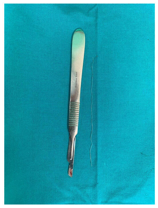 A Rare Case of Dirofilariasis in the Genian Region