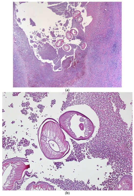 A Rare Case of Dirofilariasis in the Genian Region