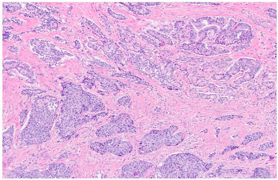 Primary Adenosquamous Carcinoma of the Prostate