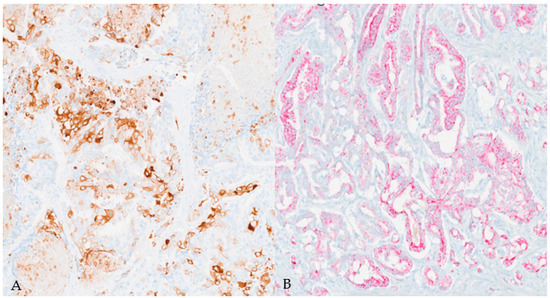 Primary Adenosquamous Carcinoma of the Prostate