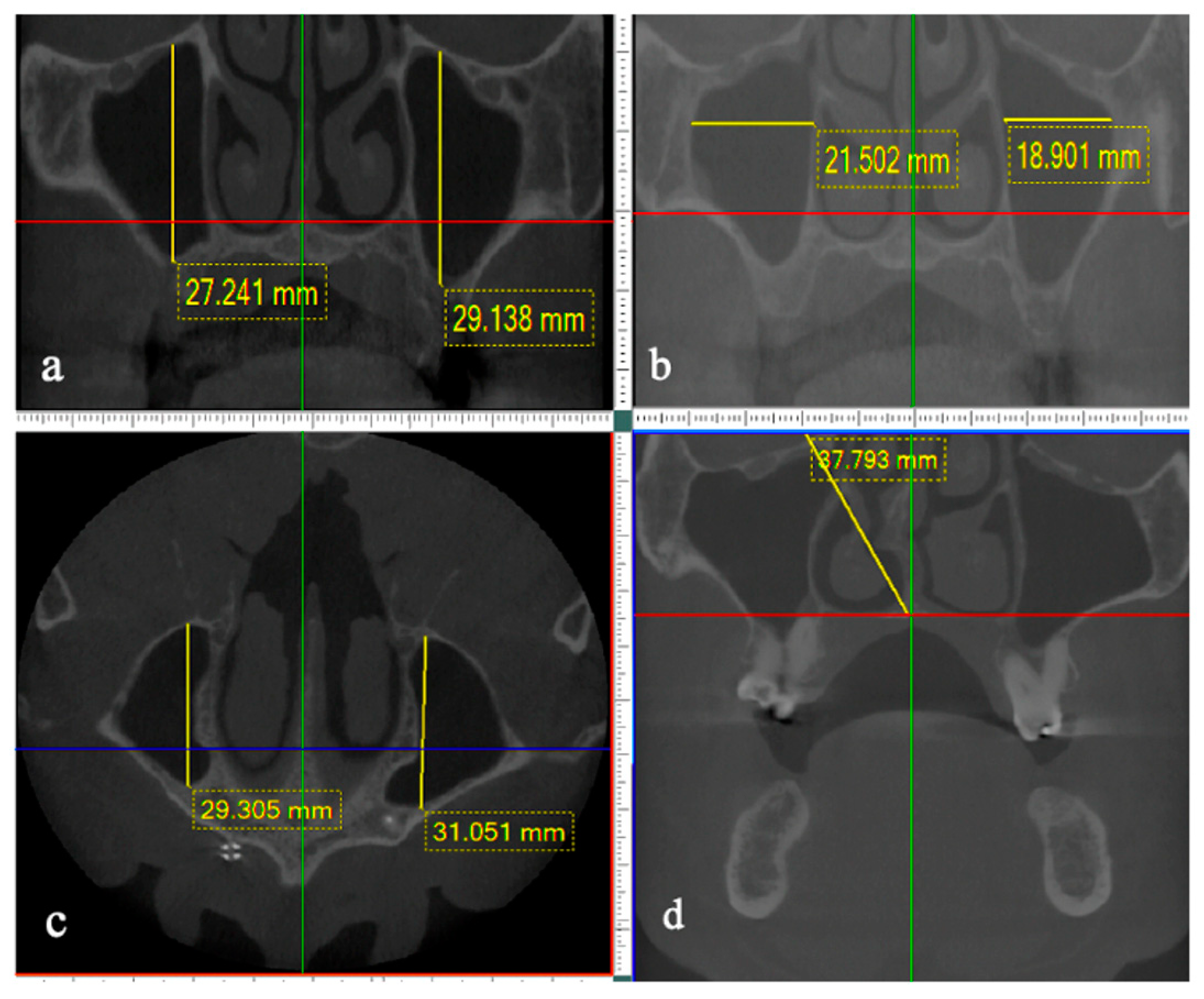 Diagnostics Free Full Text Relationship Of Maxillary Sinus Volume