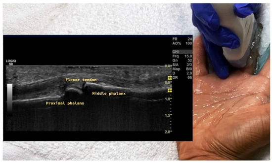 Development of a Musculoskeletal Ultrasound Protocol to Evaluate Hand ...