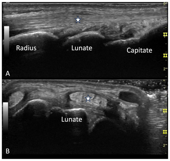 Development of a Musculoskeletal Ultrasound Protocol to Evaluate Hand ...