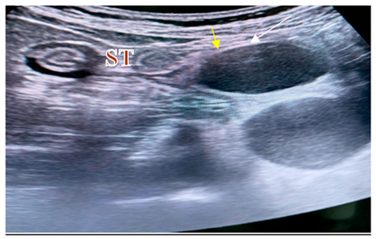Uncommon Presentation of Gastric Duplication Cyst with Left-Sided Portal Hypertension: A Case ...