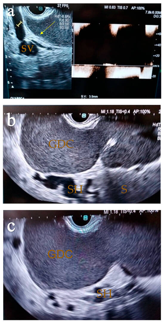 Uncommon Presentation of Gastric Duplication Cyst with Left-Sided Portal Hypertension: A Case ...
