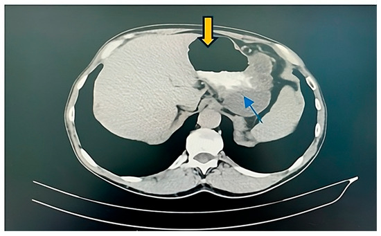 Uncommon Presentation of Gastric Duplication Cyst with Left-Sided Portal Hypertension: A Case ...