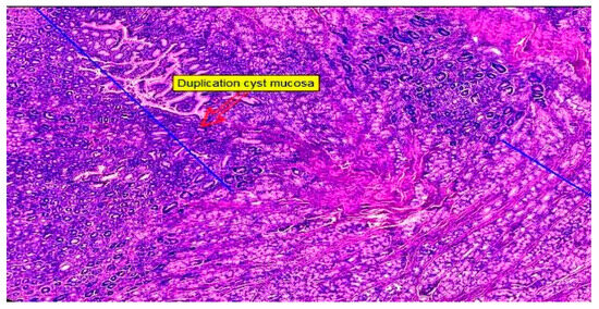 Uncommon Presentation of Gastric Duplication Cyst with Left-Sided Portal Hypertension: A Case ...