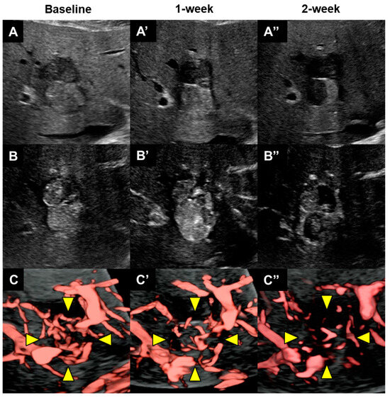 Noninvasive Visualization of Tumor Blood Vessels within Hepatocellular ...