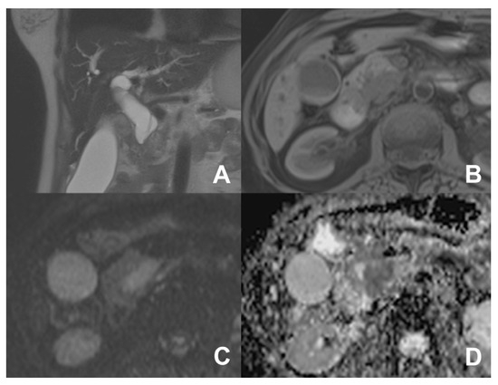 Imaging of the Liver and Pancreas: The Added Value of MRI