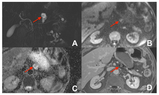Imaging of the Liver and Pancreas: The Added Value of MRI