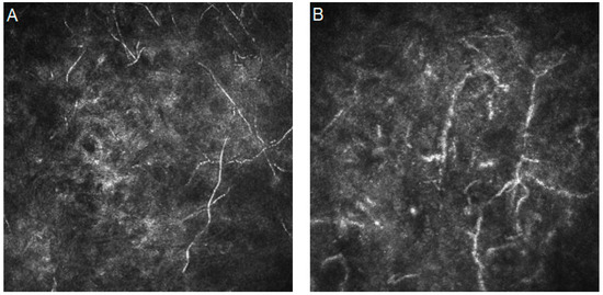 Artificial-Intelligence-Enhanced Analysis of In Vivo Confocal Microscopy in Corneal Diseases: A ...