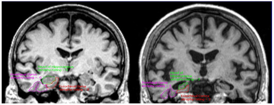 Neuropathology, Neuroimaging, and Fluid Biomarkers in Alzheimer’s Disease