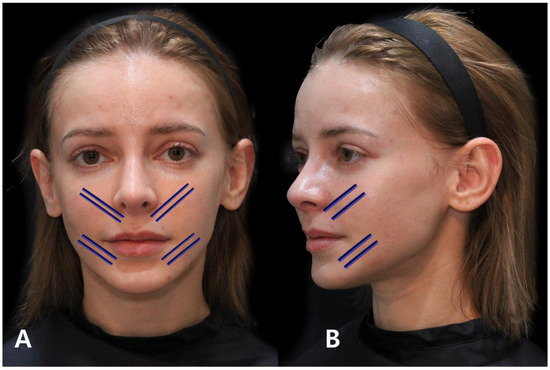 Why Do Nasolabial Folds Appear? Exploring the Anatomical Perspectives ...