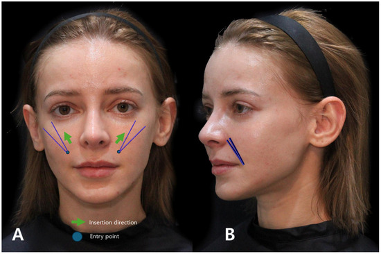 Why Do Nasolabial Folds Appear? Exploring the Anatomical Perspectives ...
