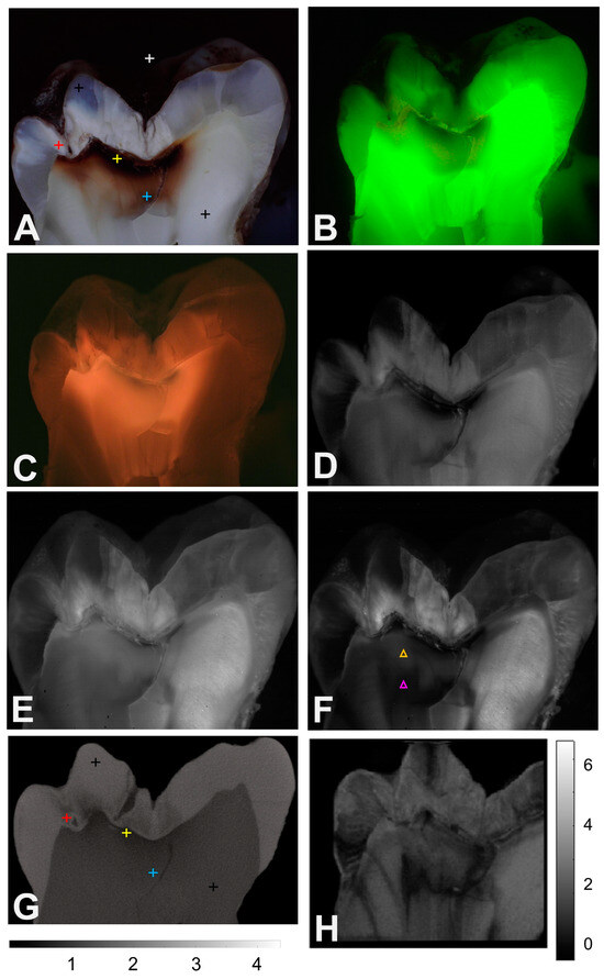 Short Wavelength Infrared Imaging Of Infected And Affected Dentin