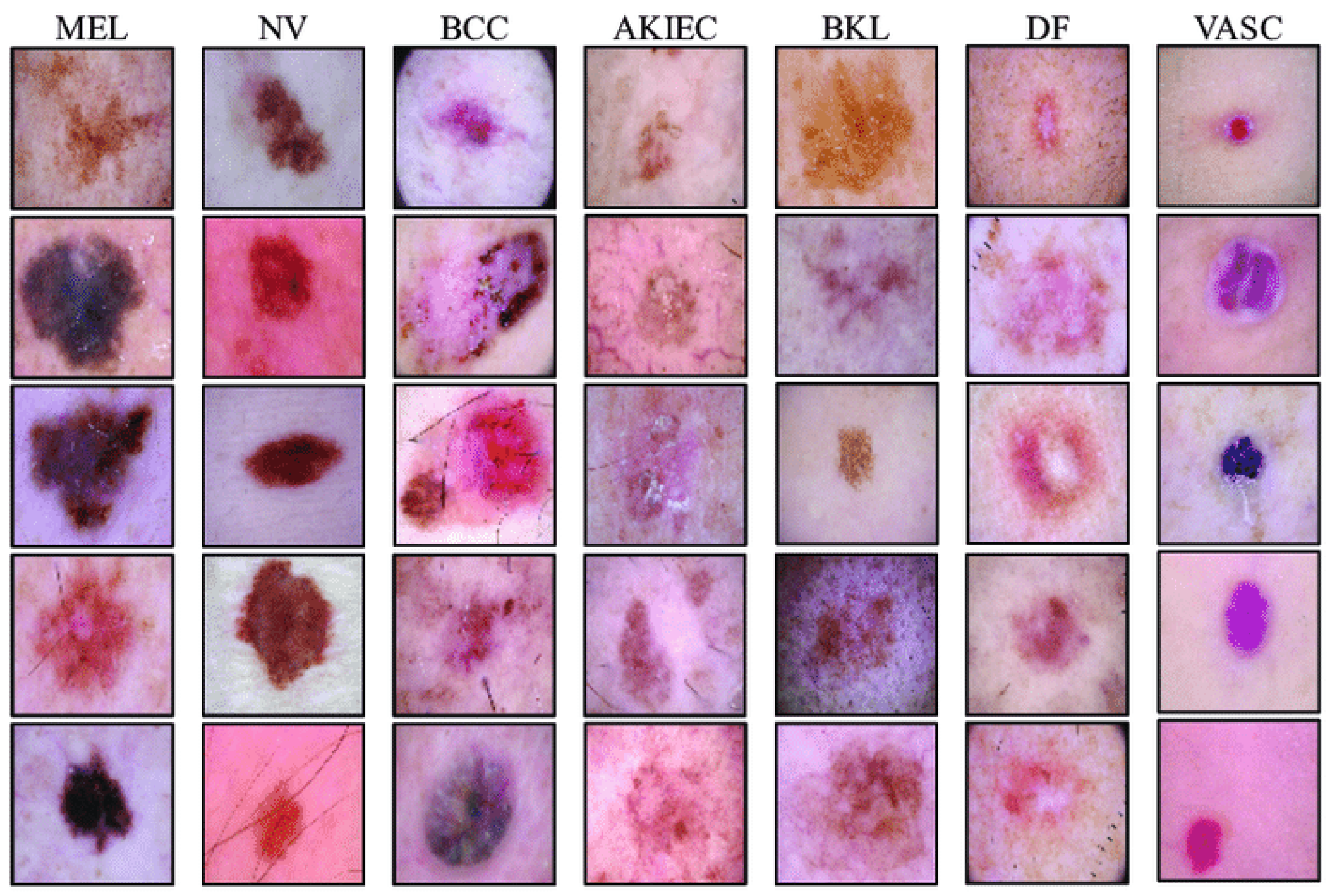 Advancing Dermatological Diagnostics: Interpretable AI for Enhanced ...
