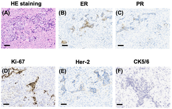 Occult Breast Cancer Presenting as Sternum Pain