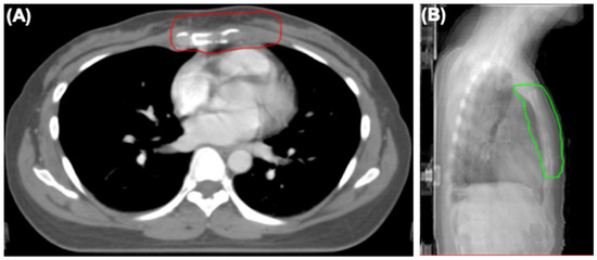 Occult Breast Cancer Presenting as Sternum Pain