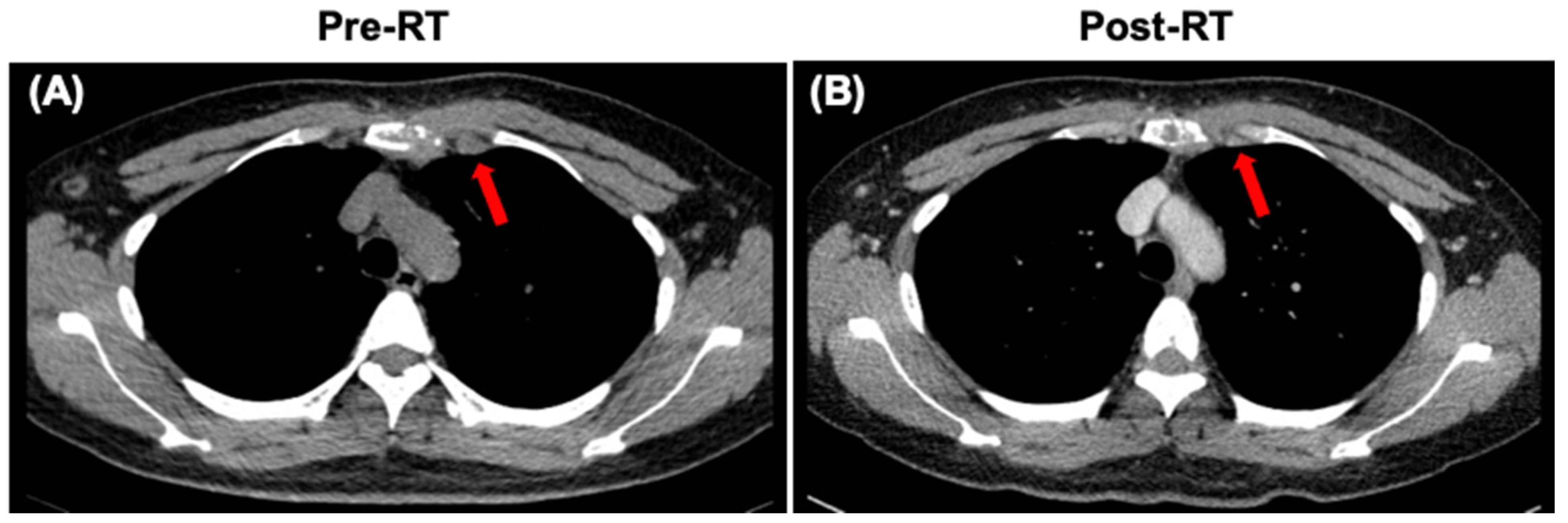 Occult Breast Cancer Presenting as Sternum Pain