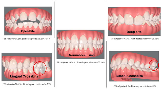 Comprehensive Oral Diagnosis and Management for Women with Turner Syndrome