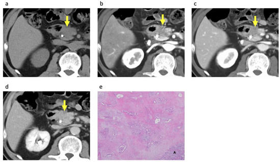 Rim Enhancement on Contrast-Enhanced CT as a Predictor of Prognosis in ...