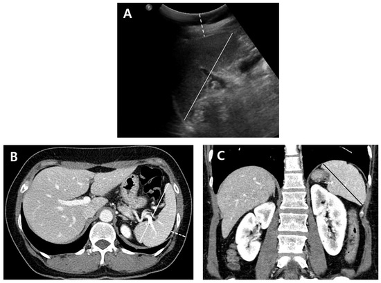 Discrepancies in Splenic Size Measurement: A Comparative Analysis of ...