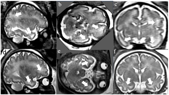 Association between White Matter T2 Hyper-Intense Signals in Fetal Brain Magnetic Resonance ...