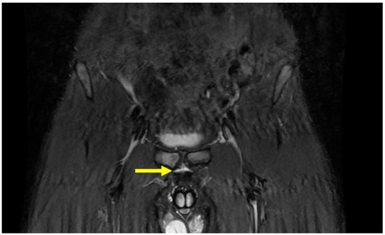The Role of MRI in Groin Pain Syndrome in Athletes