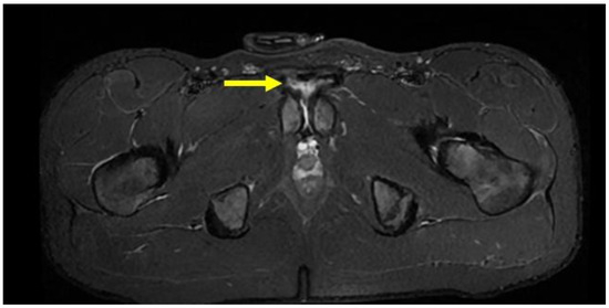 Diagnostics | Free Full-Text | The Role of MRI in Groin Pain Syndrome ...