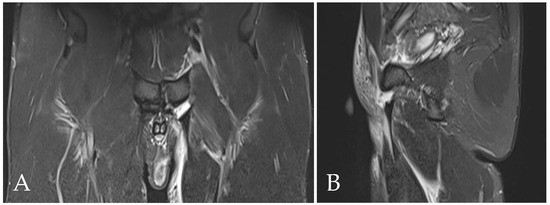The Role of MRI in Groin Pain Syndrome in Athletes