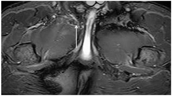 Diagnostics | Free Full-Text | The Role of MRI in Groin Pain Syndrome ...