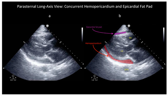 Blood or Fat? Differentiating Hemopericardium versus Epicardial Fat ...