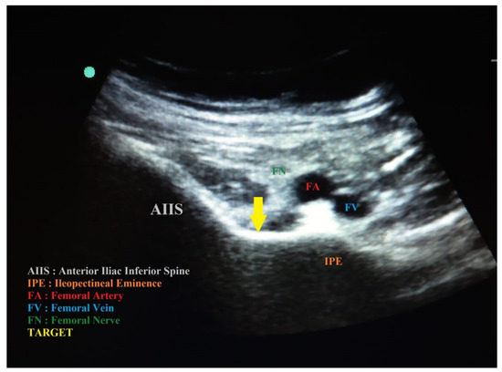 The Effects of the Pericapsular Nerve Group Block on Postoperative Pain ...