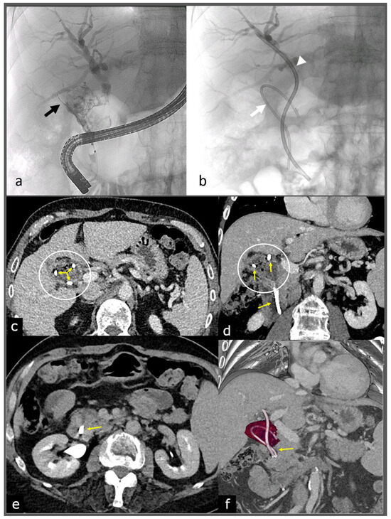 Endoscopic Retrograde Cholangiopancreatography (ERCP) for Suspected ...