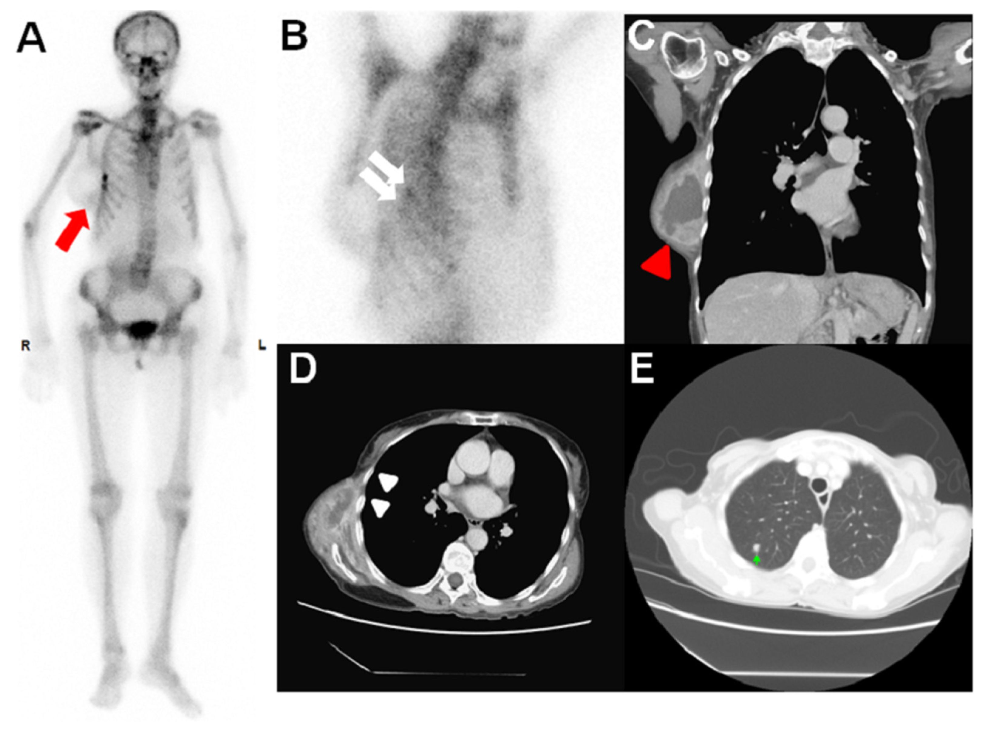 Diagnostics | Free Full-Text | Myxofibrosarcoma of the Chest Wall ...